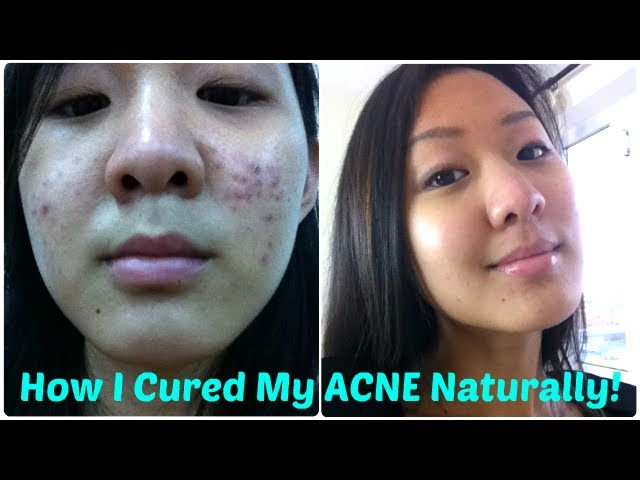 How can I clear my acne naturally?
