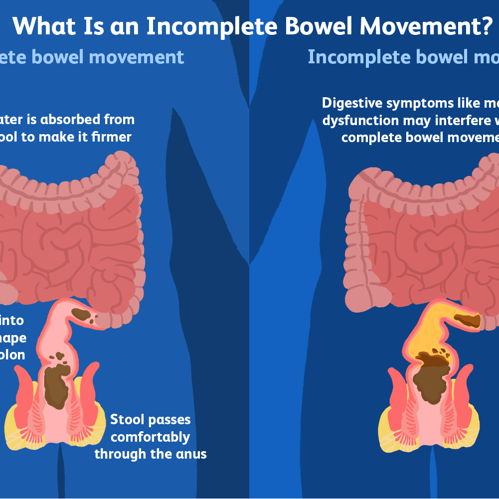 How can I get my bowel movement to work?