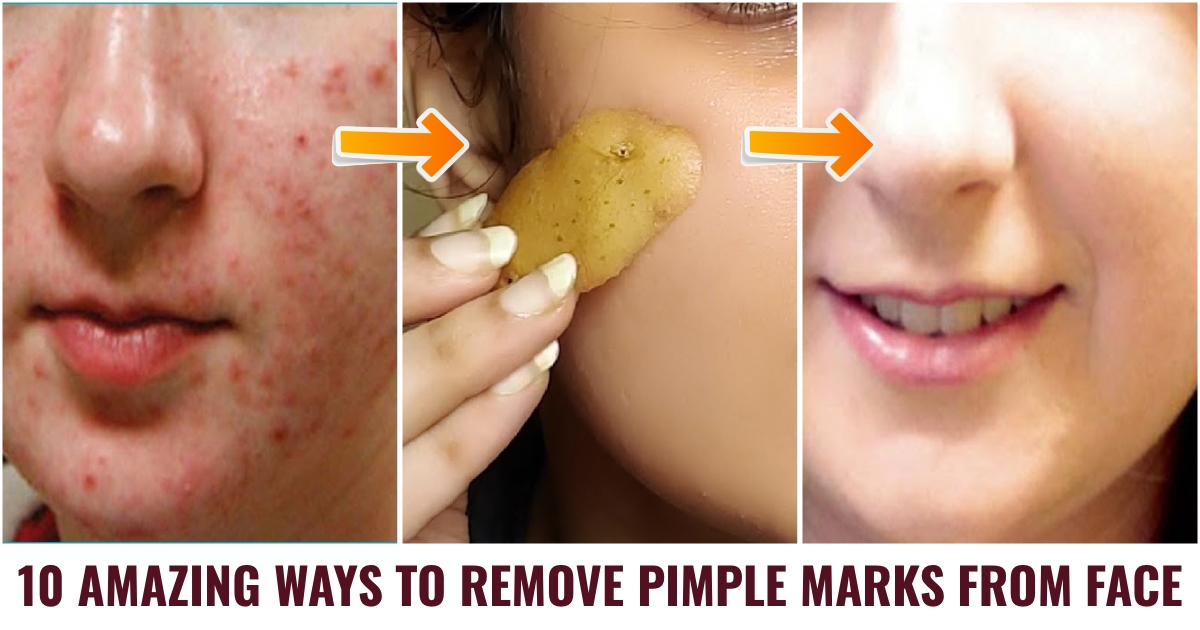 How can I remove pimples from my face?