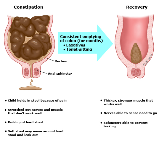 How can I stop being constipated?