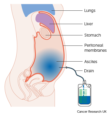 How do I get rid of excess fluid in my stomach?