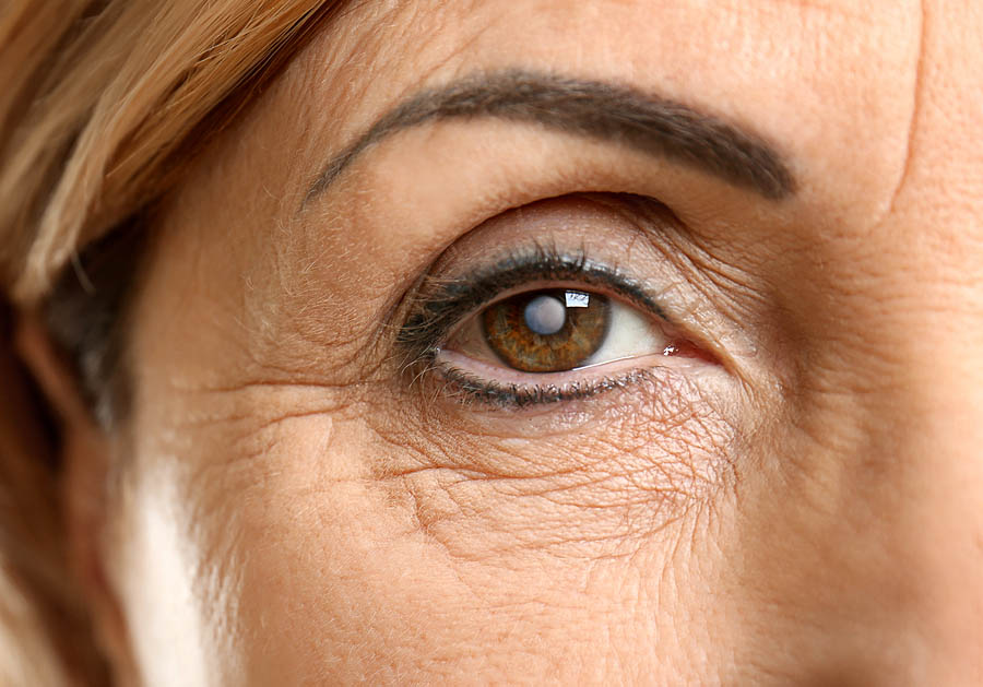 How do I know if I have cataracts?