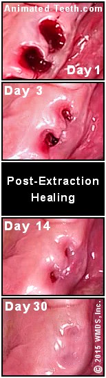 How do I know if my tooth extraction is healing properly?