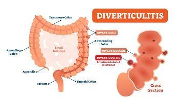 How do I stop flatulence from diverticulitis?