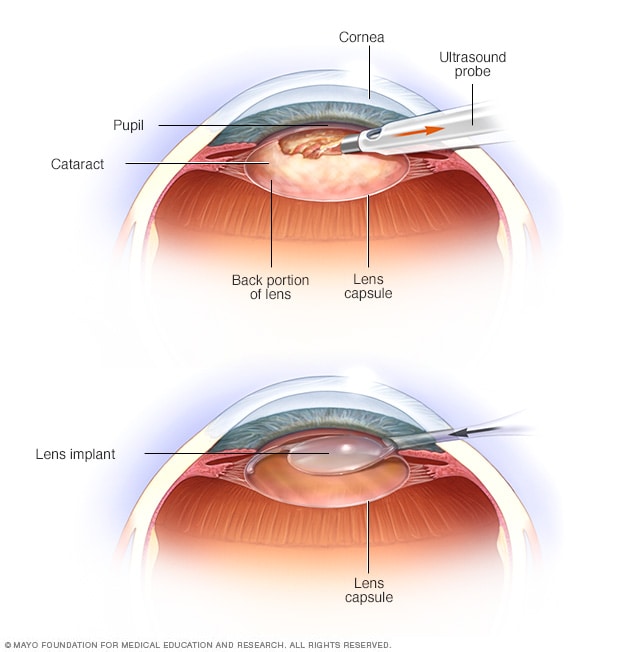 How do they remove a cataract?