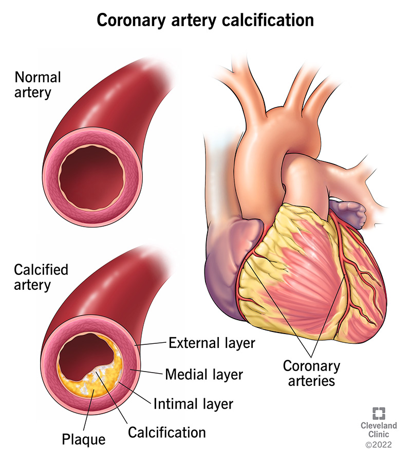 How do you clear calcified arteries?