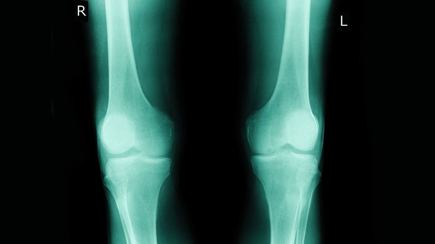 How do you fix bone density loss?