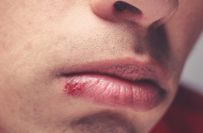 How do you get rid of a cold sore fast?