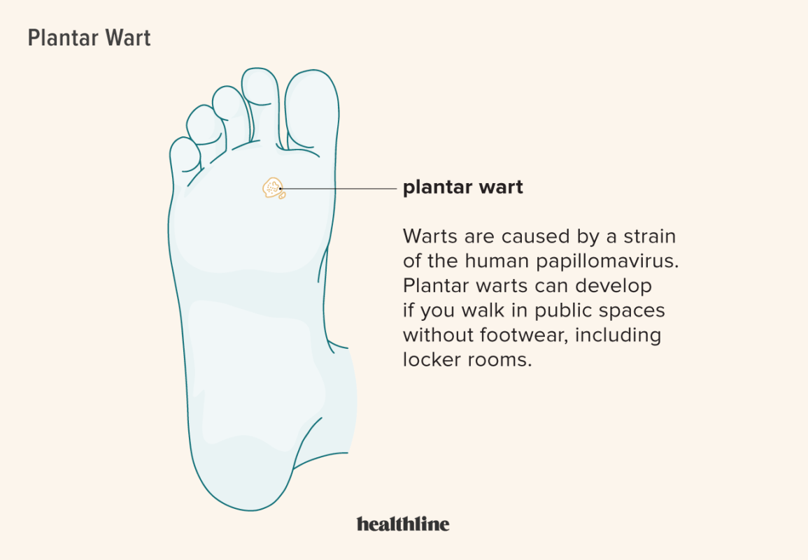 How do you get rid of a planters wart at home?