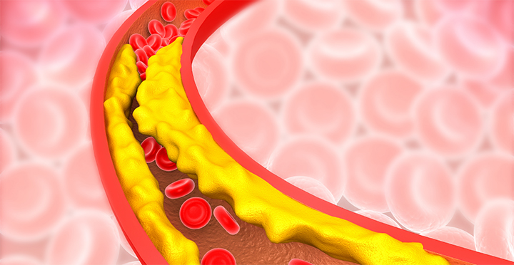 How do you get rid of calcium deposits in your arteries?
