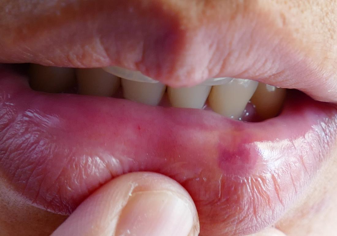 How do you heal a deep lip fast?