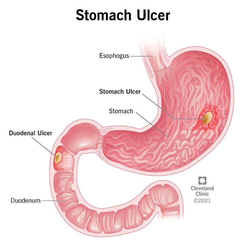 How do you heal a stomach ulcer completely?