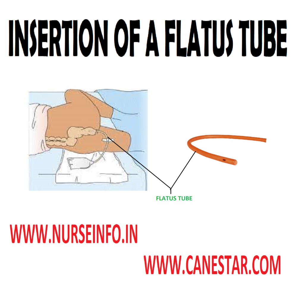 How do you insert a flatus tube?
