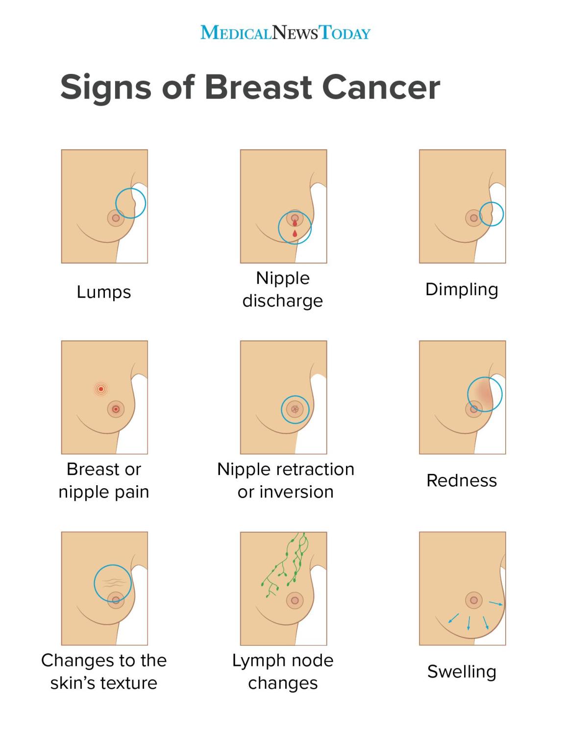 How do you know if a lump is cancerous?