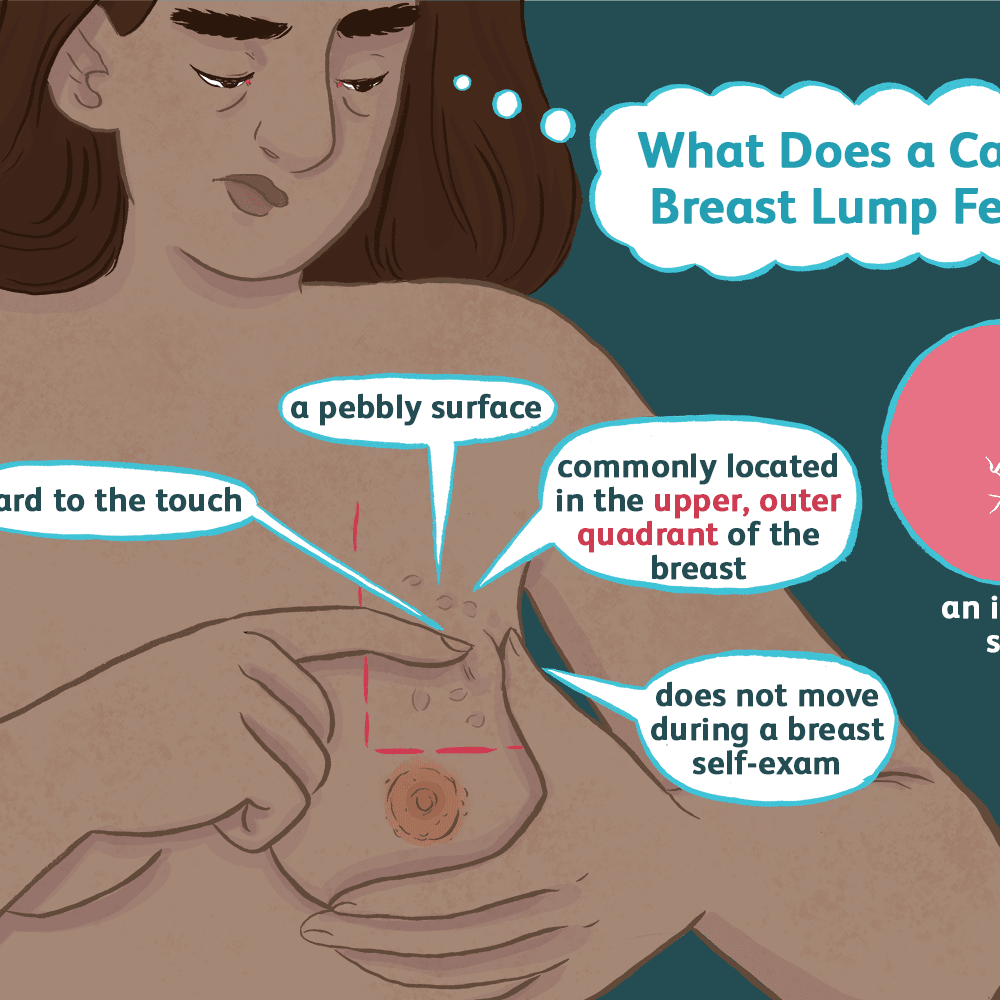 How do you know if a lump is worrisome?