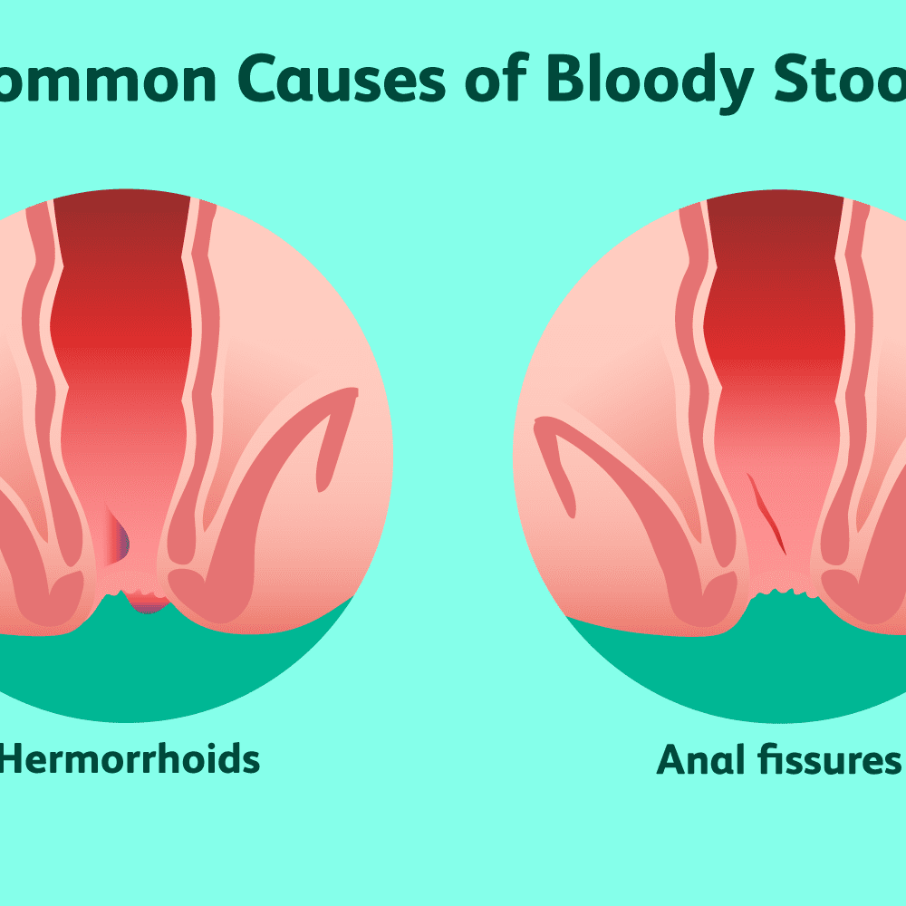 How do you know if blood in stool is serious?
