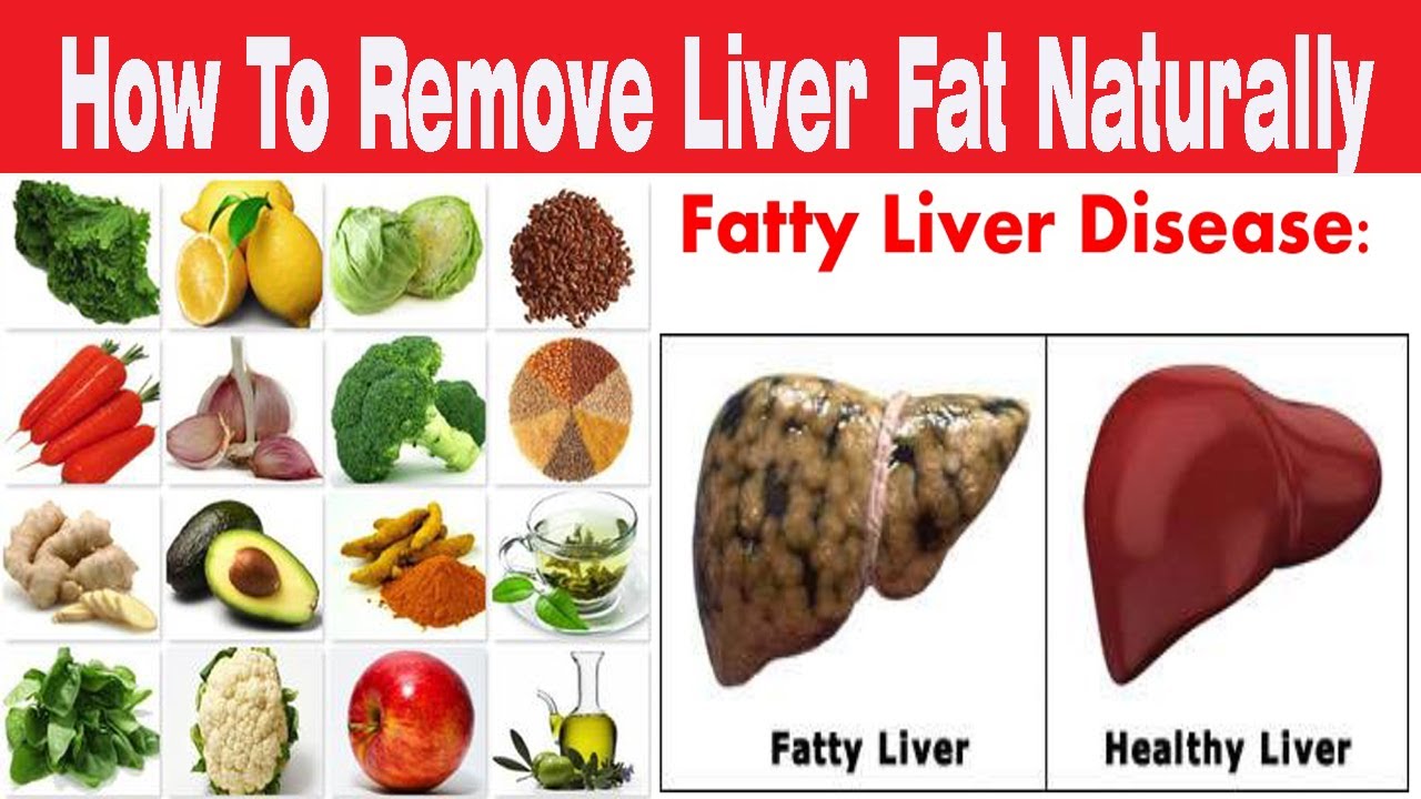 How do you remove fat from your liver naturally?