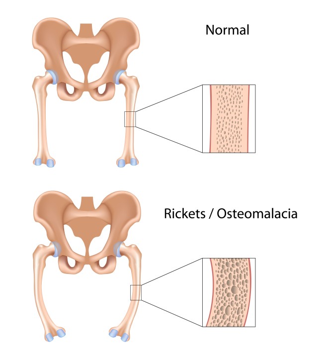 How do you soften bones?