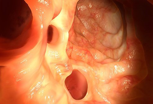 How do you stop a diverticulitis flare-up?