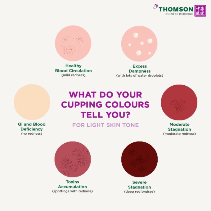 How does cupping make you feel?