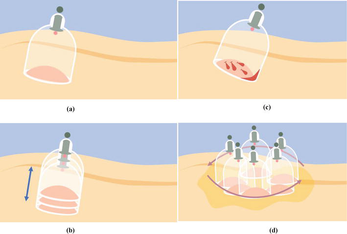 How does cupping relieve pain?