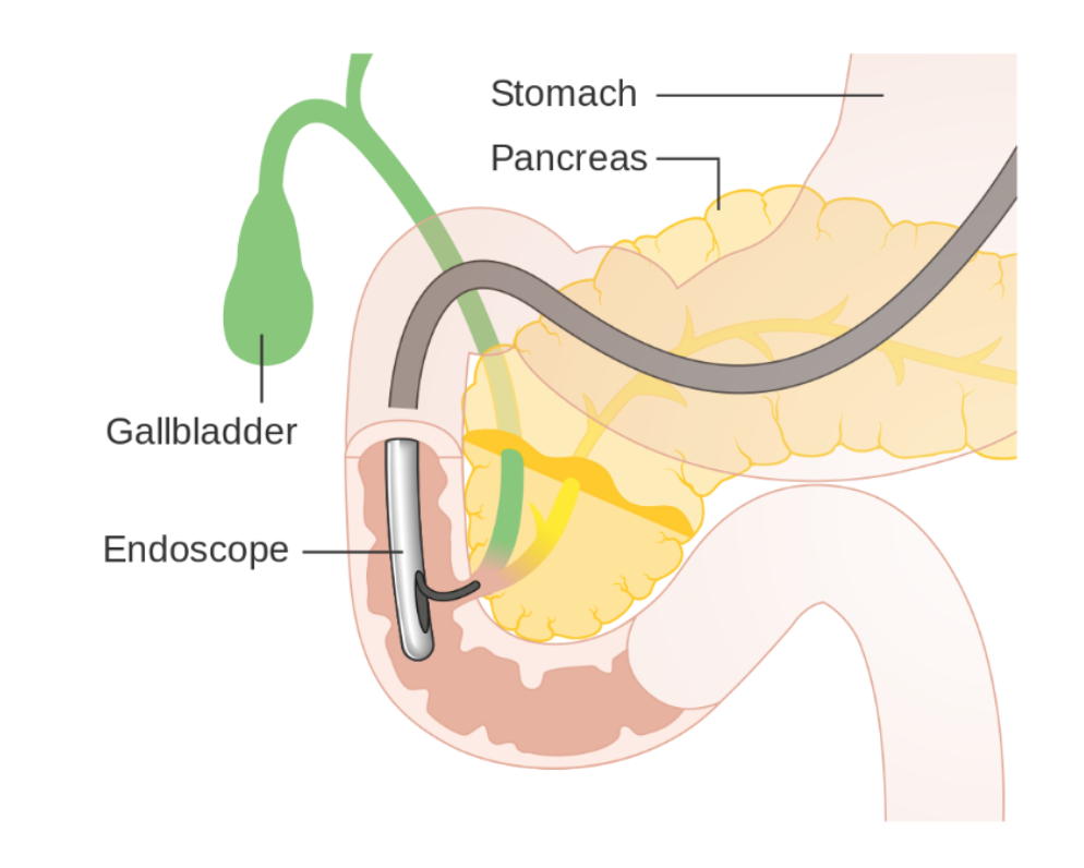 How long does abdominal pain last after ERCP?