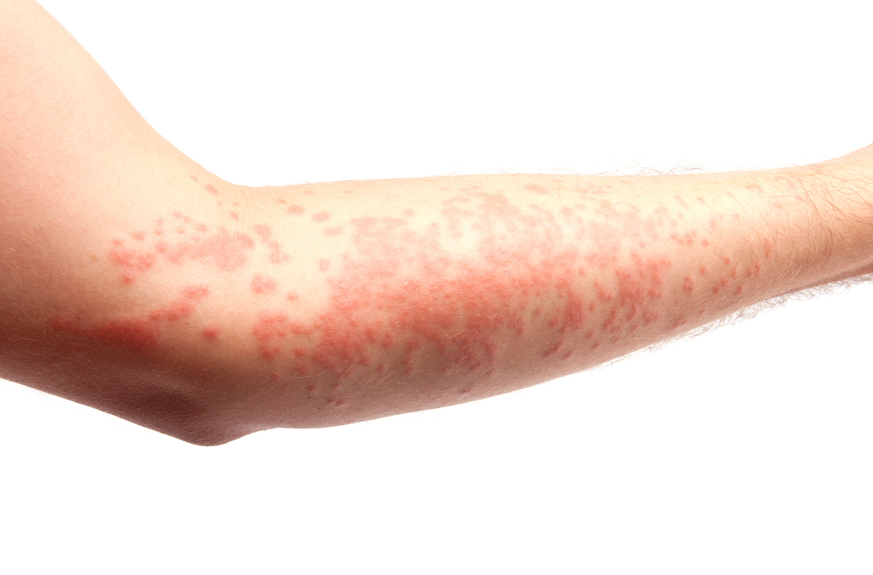 How long does an allergic reaction last?