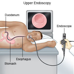 How long does bloating last after endoscopy?