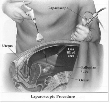 How long does gas pain last after laparoscopy?