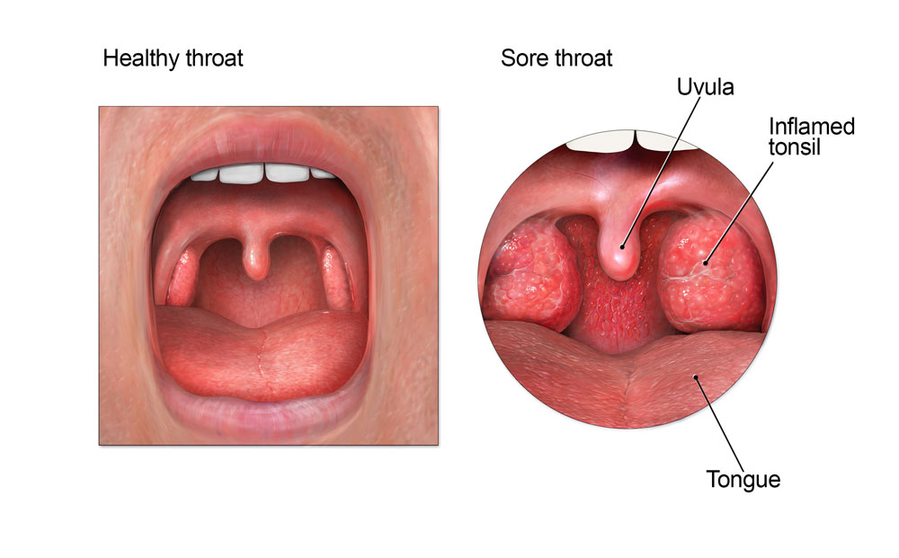 How long does it take a sore throat to go away on its own?