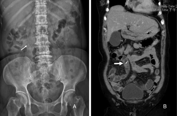 How long does it take for bones to dissolve in stomach acid?