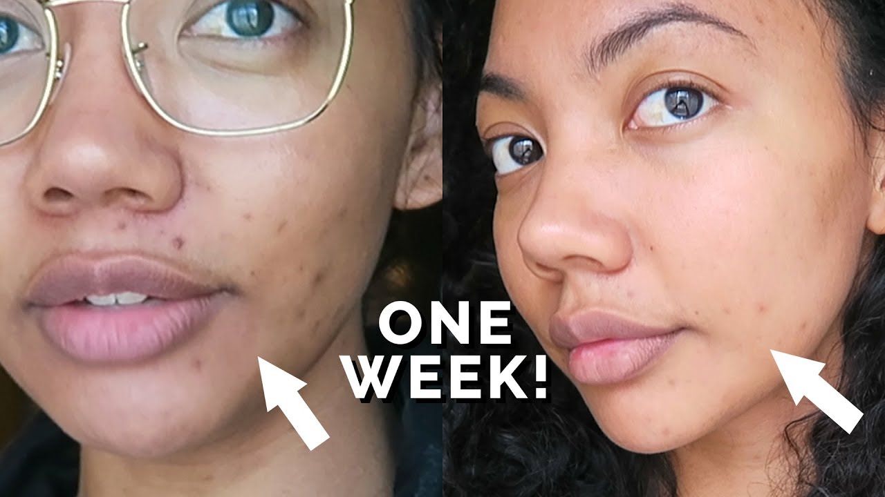 How long does it take for dark spots to fade?