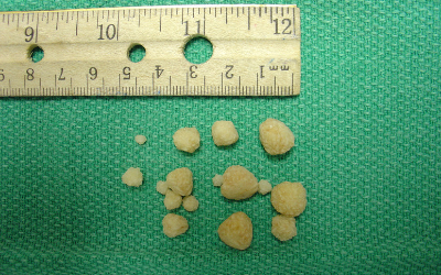 How long does it take for dogs to pass bladder stones?