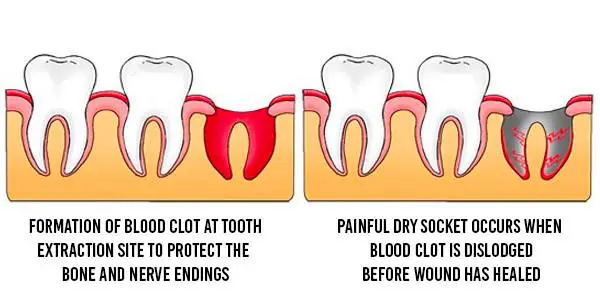 How long does it take for the hole to close after a tooth extraction?
