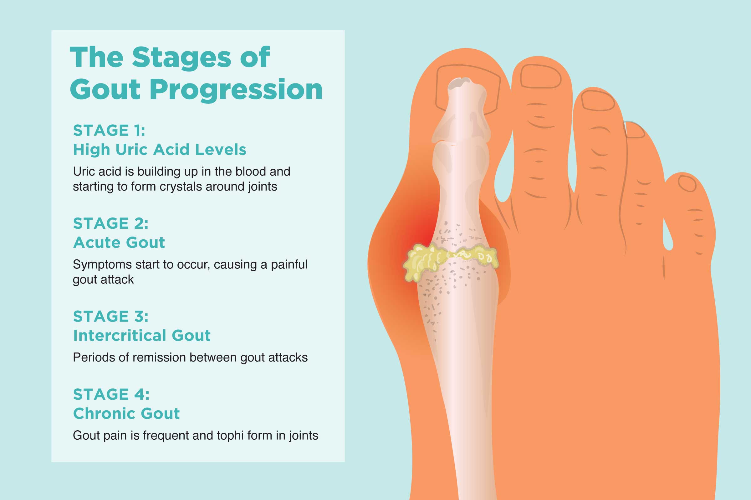 How long does it take to get rid of uric acid?