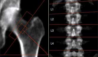 How long does it take to regain bone density?