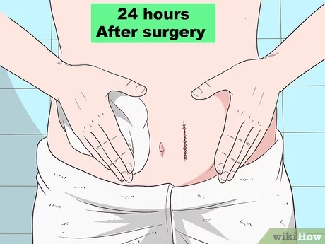 How long does post surgery bloating last?