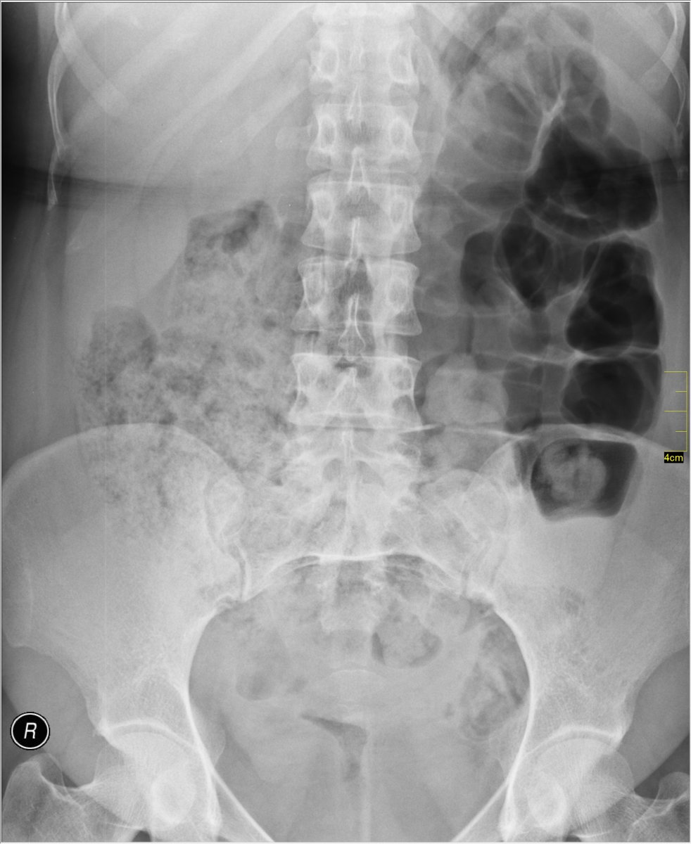 How long does trapped gas last after surgery?