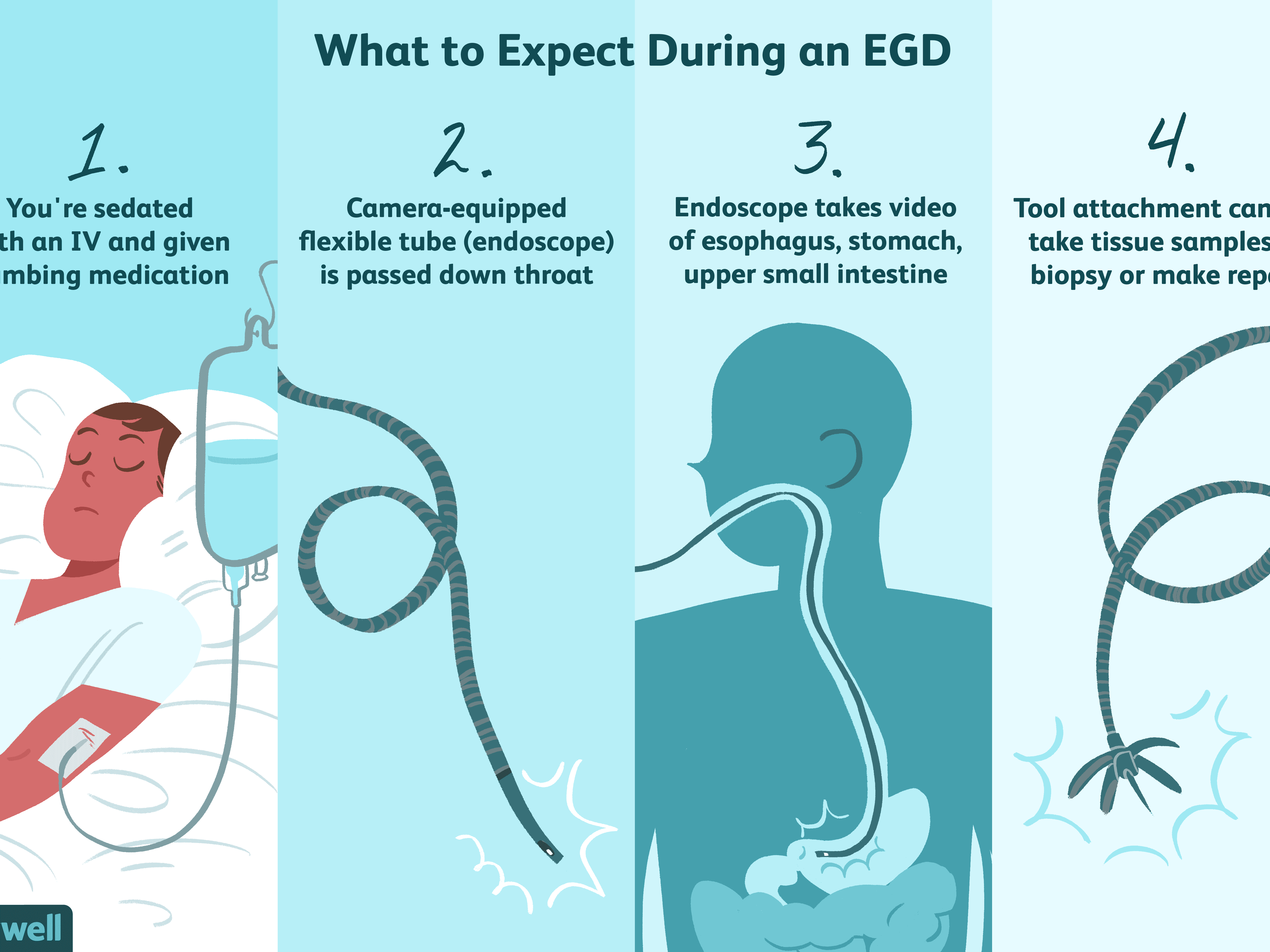 How long does your stomach hurt after an endoscopy?