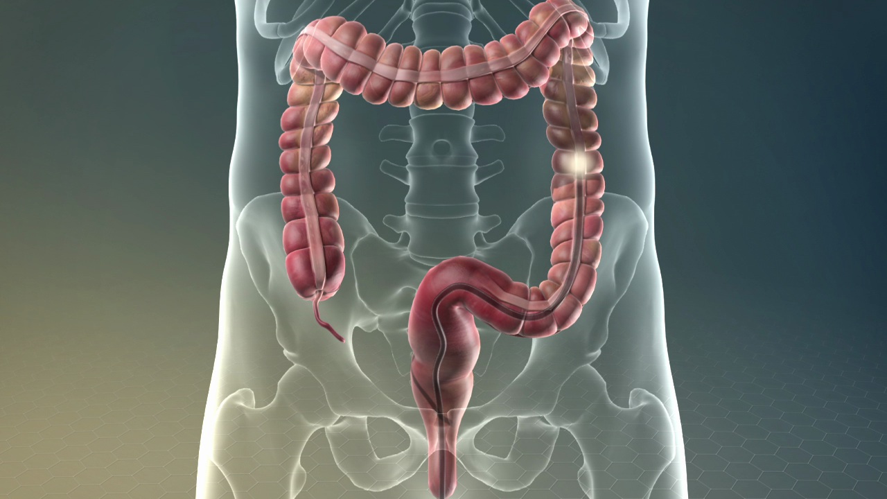 How long does your stomach stay bloated after colonoscopy?