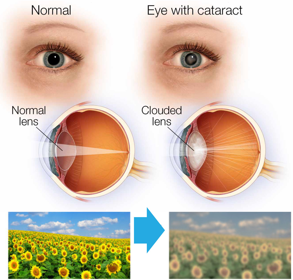 How serious is a cataract?