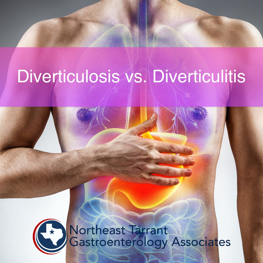 Is bloating common with diverticulitis?
