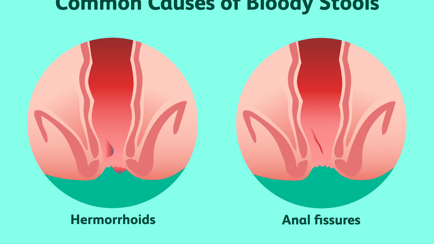 Is blood in your stool life threatening?