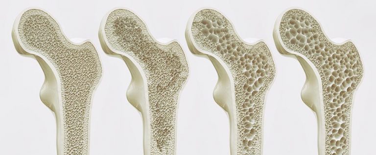 Is bone density loss reversible?