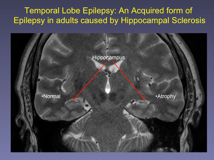 Is epilepsy a mystery?