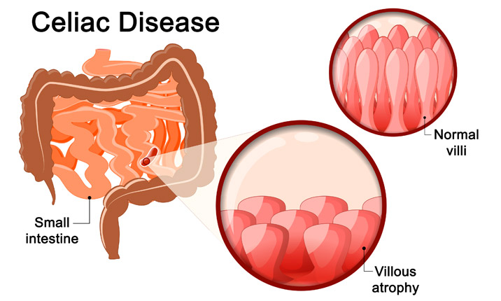 Is gluten hard on the digestive system?