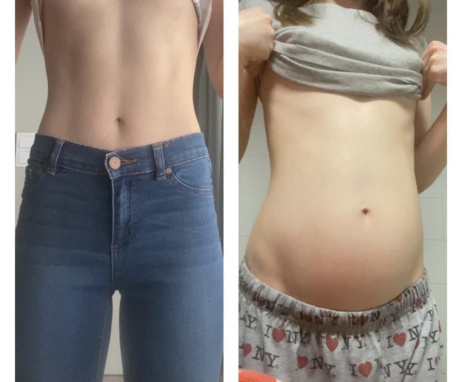 Is it normal to have a bloated stomach everyday?