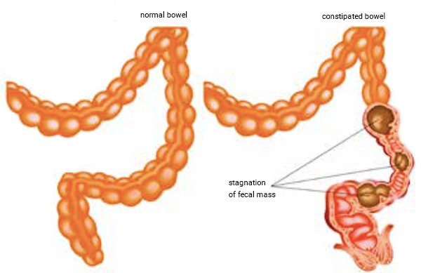 Is it normal to have constipation for a long time?