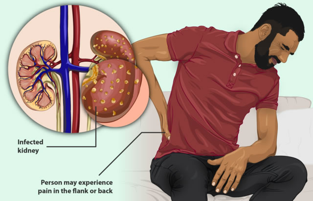 Is it obvious when you have a kidney infection?