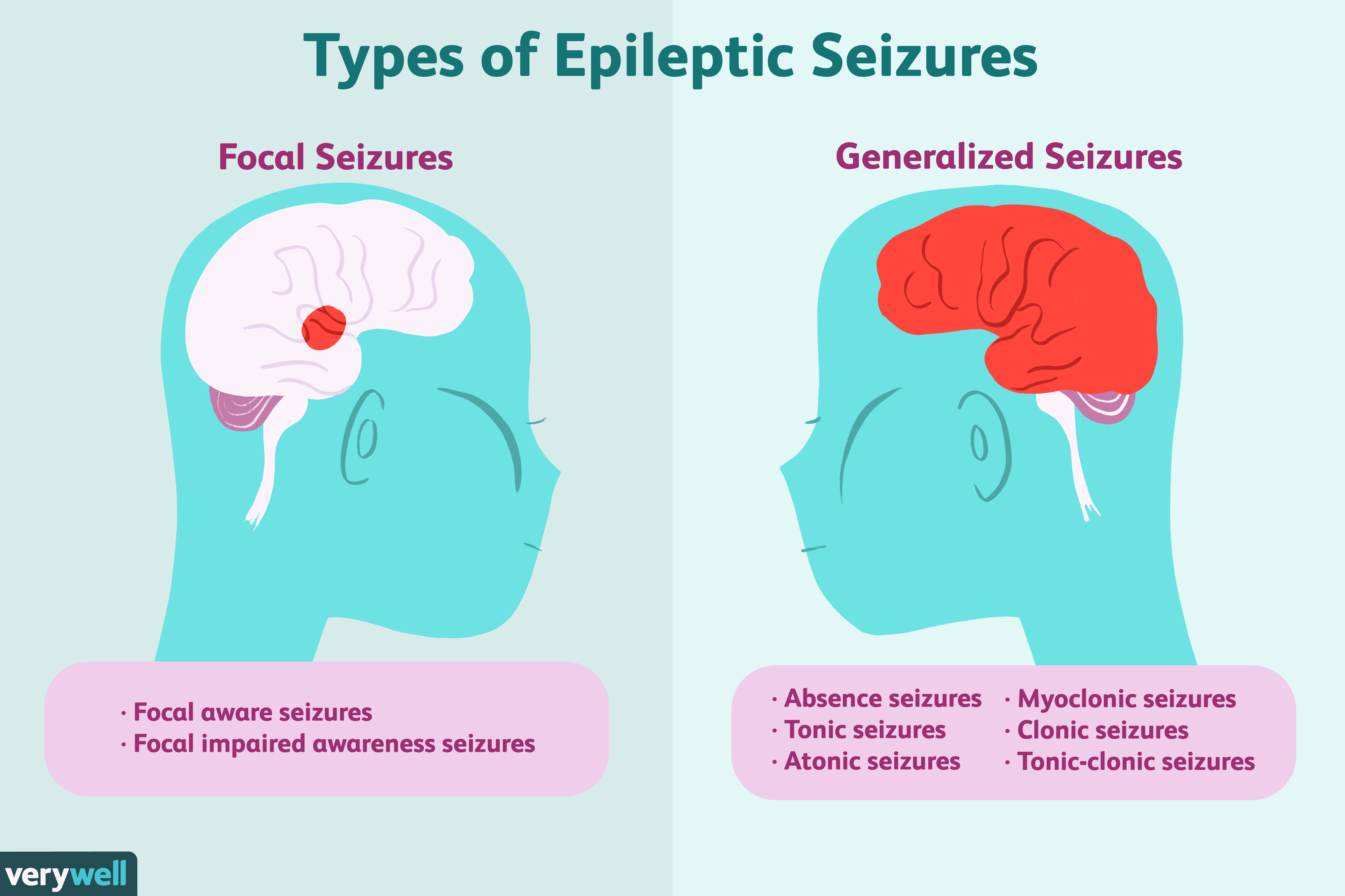 Is there a cure for epilepsy 2020?